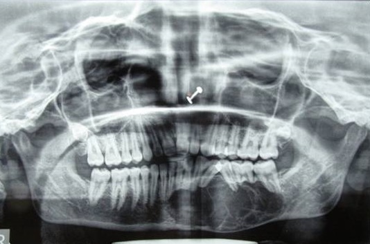 Ossifying Fibroma Radiology