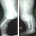 Femoral bifurcation and bilateral tibial hemimelia: case report