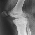 Triplane fracture of the proximal tibia: a case report and literature ...