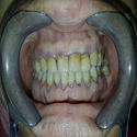 Oral disorders related to acromegaly