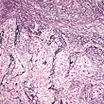 Gliosarcoma case report and review of the literature