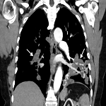 Unusual cause of filling defect in pulmonary artery: pulmonary artery ...