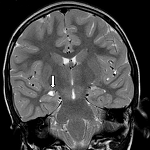 Temporal choroidal fissure cyst: a rare cause of temporal lobe epilepsy