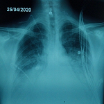 A misleading CMV myocarditis during the COVID-19 pandemic: case report