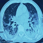 COVID-19 and fortuitous discovery of chronic lymphocytic leukemia ...