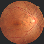 Clinical characteristics and treatment outcomes of angioid streak ...