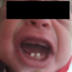 Natal teeth: report of two cases
