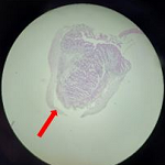Cysticercose disséminée à localisation neurologique, oculaire et ...
