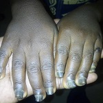 Twenty-Nail-Dystrophy (TND) / Trachyonychia: a case report in a five ...