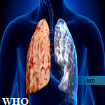 Dilatations des bronches chez les patients porteurs de ...