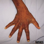 Scabies and its associated factors among under 15 years children in ...