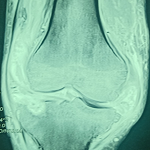 L´arthrite tuberculeuse isolée du genou, un diagnostic difficile chez l ...