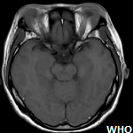 A case report of Mikulicz's disease