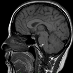 Intracranial neuro-enteric cyst: an illustrative patient and review