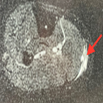 Syndrome de loges compliquant un tennis leg: rapport de cas