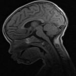 Traumatic retroclival subdural hematoma: case report and a review of ...