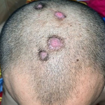 Wart On Scalp