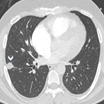 Pulmonary infarction mimicking a lung mass: a case report