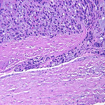 Nature and outcome of malignant goiter: a revisit