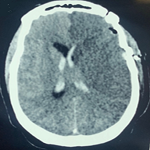 Decompressive craniectomy: indications and results of 24 cases at the ...