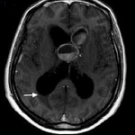 Ruptured intraventricular tuberculous brain abscess mimicking cystic ...