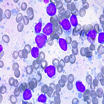 Blastoid mantle cell lymphoma presenting as acute leukemia: a case report