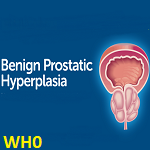 Surgical management of benign prostate hyperplasia in Nigeria: open ...