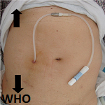 Peritoneal dialysis in Tunisia: complications, technique and patient´s ...