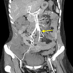 Syndrome de Leriche chez une jeune femme de 20 ans: à propos d´un cas