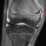 Incarcération du périoste dans le cartilage de croissance dans une ...