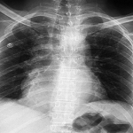 Myocardial infarction revealing a pleuropericardial cyst: a case report