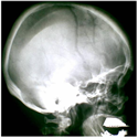 Bilateral thinning of the parietal bones: a case report and review of ...