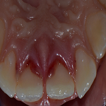 Management of extrusive luxation of upper incisors in young permanent ...