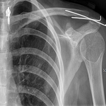 An innovative fixation technique by osteosuture in a young athletic ...