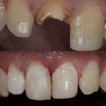 Intra-radicular reinforcement using a modified fiber post customization ...