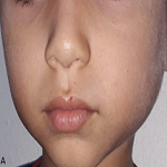 Juvenile recurrent parotitis in a 4-year-old patient: a case report