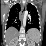 Esophageal tuberculosis as an unusual cause of dysphagia: a case report