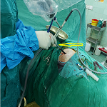 Mini-percutaneous nephrolithotomy via ultrasound guidance in ...