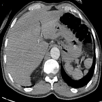 Polysplenia syndrome in adulthood: a case report