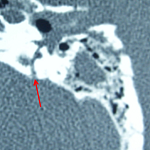 Place du scanner hélicoïdal dans le traumatisme du rocher: à propos de ...