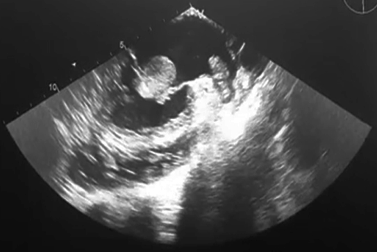 Figure 1: Concomitant existence of left atrial ball thrombus and mural ...