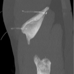 Resection of a solitary bone metastasis using preoperative computed ...