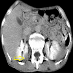 Primary diffuse large B-cell lymphoma of the right kidney: a case report
