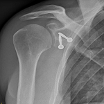 Long-term outcomes of coracoid bone block osteolysis: case report