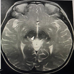 Lead poisoning with encephalic and neuropathic involvement in a child ...