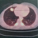 Quelle chimiothérapie dans les tumeurs phyllodes métastatiques du sein ...