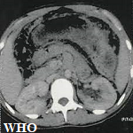 Tuberculose péritonéale pseudo tumorale: à propos d´une série de 14 cas