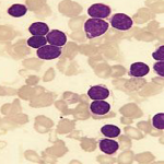 Maladie de Still de l´enfant et Leucémie aigüe lymphoblastique, une ...