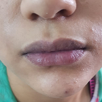 Acute dapsone poisoning with methemoglobinemia: a case report