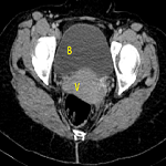 Transient urocolpos due to vesicovaginal reflux in a 37-year-old woman ...
